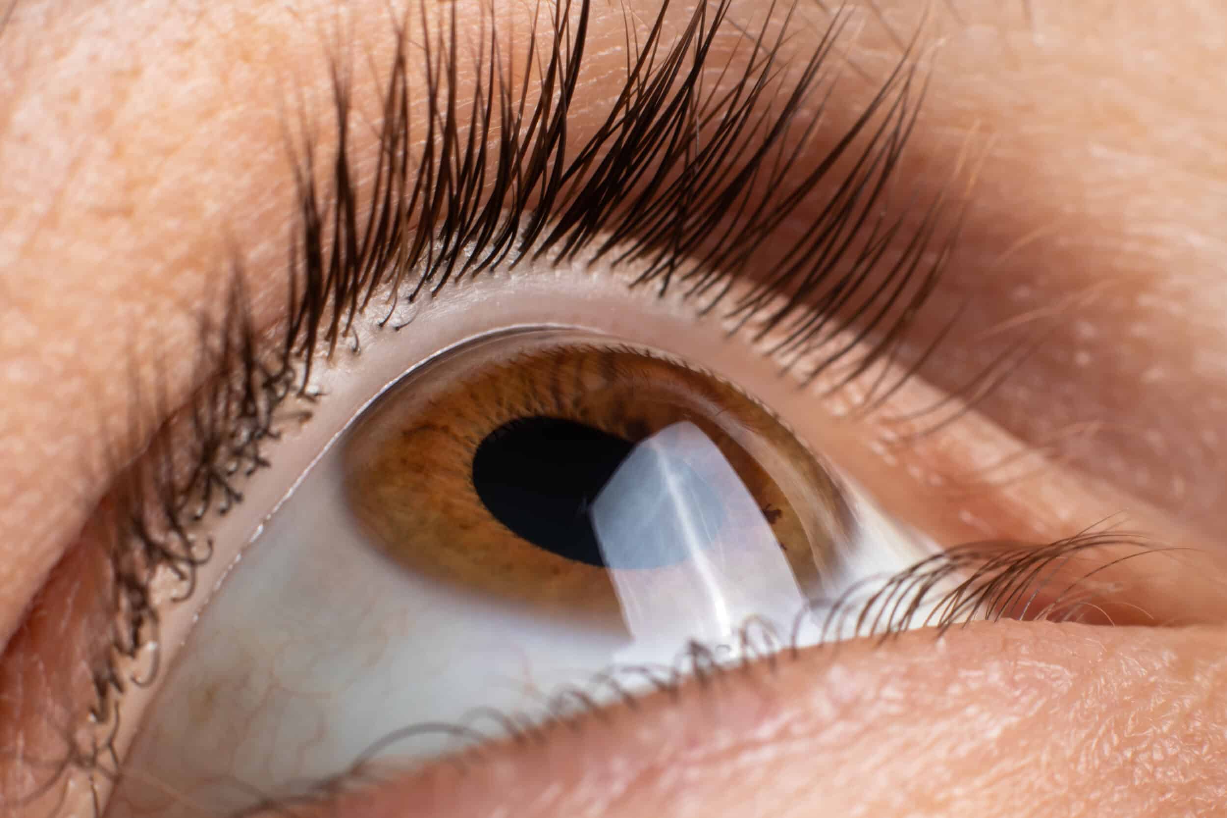 Cornea transplants: What to know - Tower Clock Eye Center